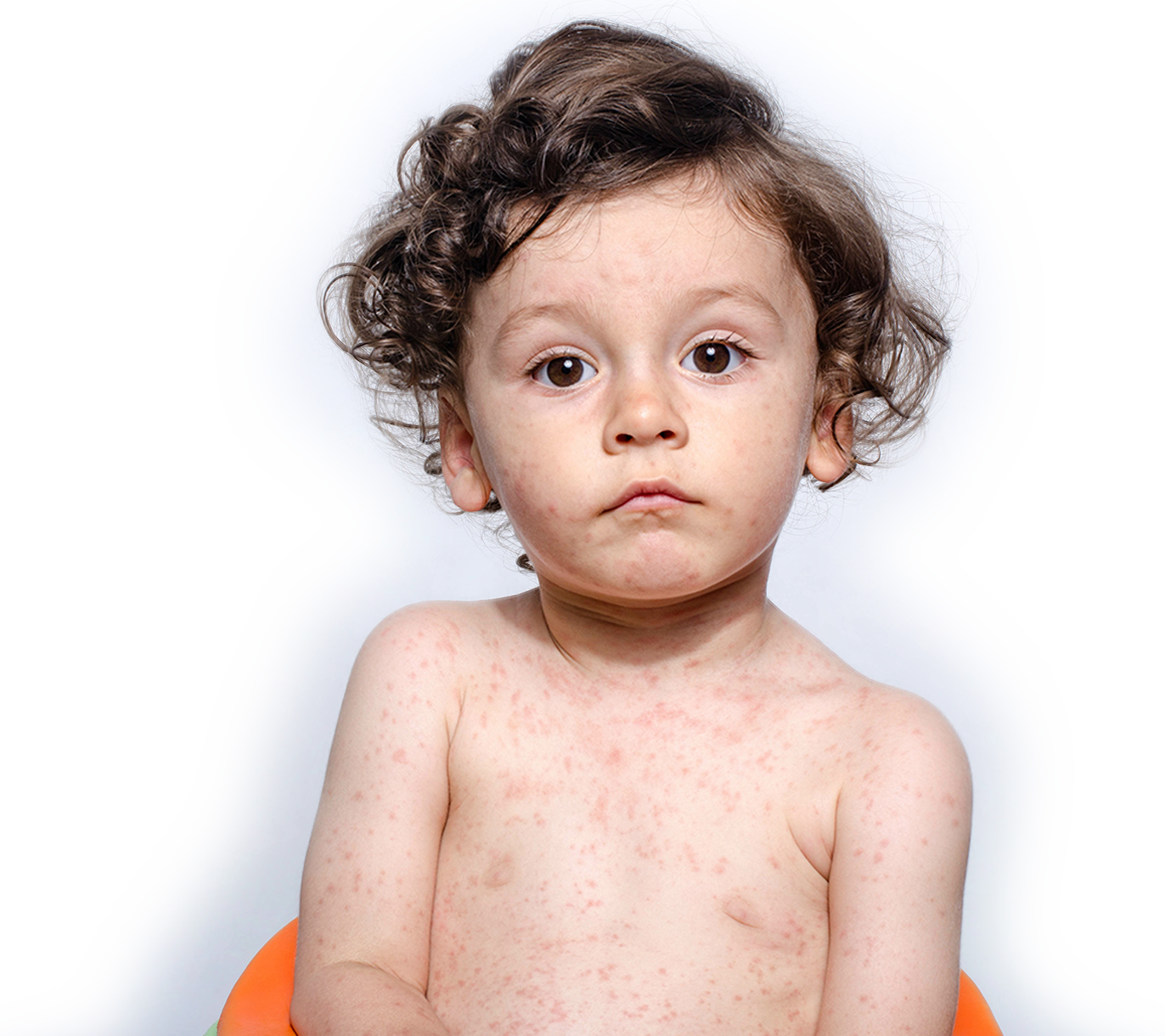 Pediatric Dermatology – Oak Tree Dermatology