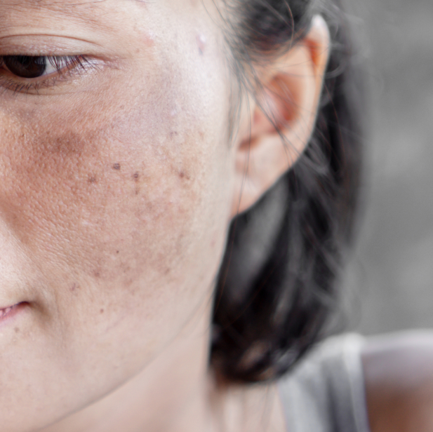 Say Goodbye to Sun Damage: Best Treatments for Dark Spots & Uneven Skin ...