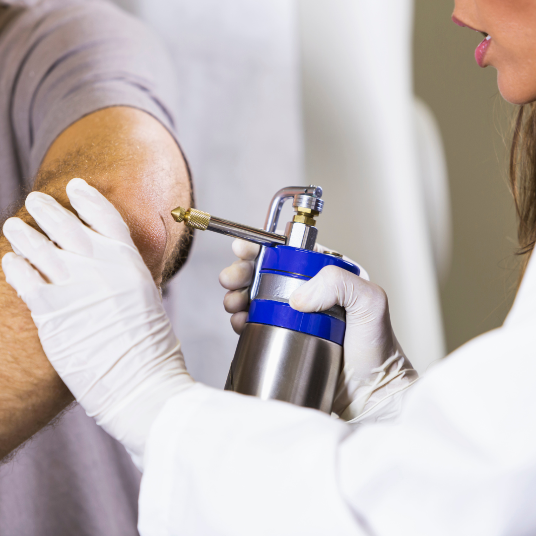 Liquid Nitrogen Treatment for Warts & Skin Growths: How It Works – Oak ...